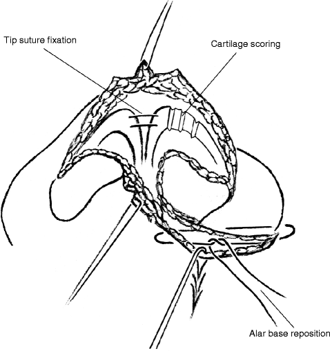 Secondary Cleft Rhinoplasty: Combining an Open Rhinoplasty with the ...