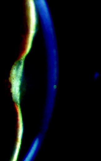 Angle Closure and Glaucoma | SpringerLink