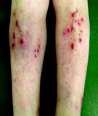 Skin Signs due to Psychiatric Morbidity: Psychogenic Skin Excoriations ...