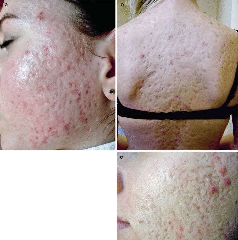 Atrophic Scars and Stretch Marks | SpringerLink