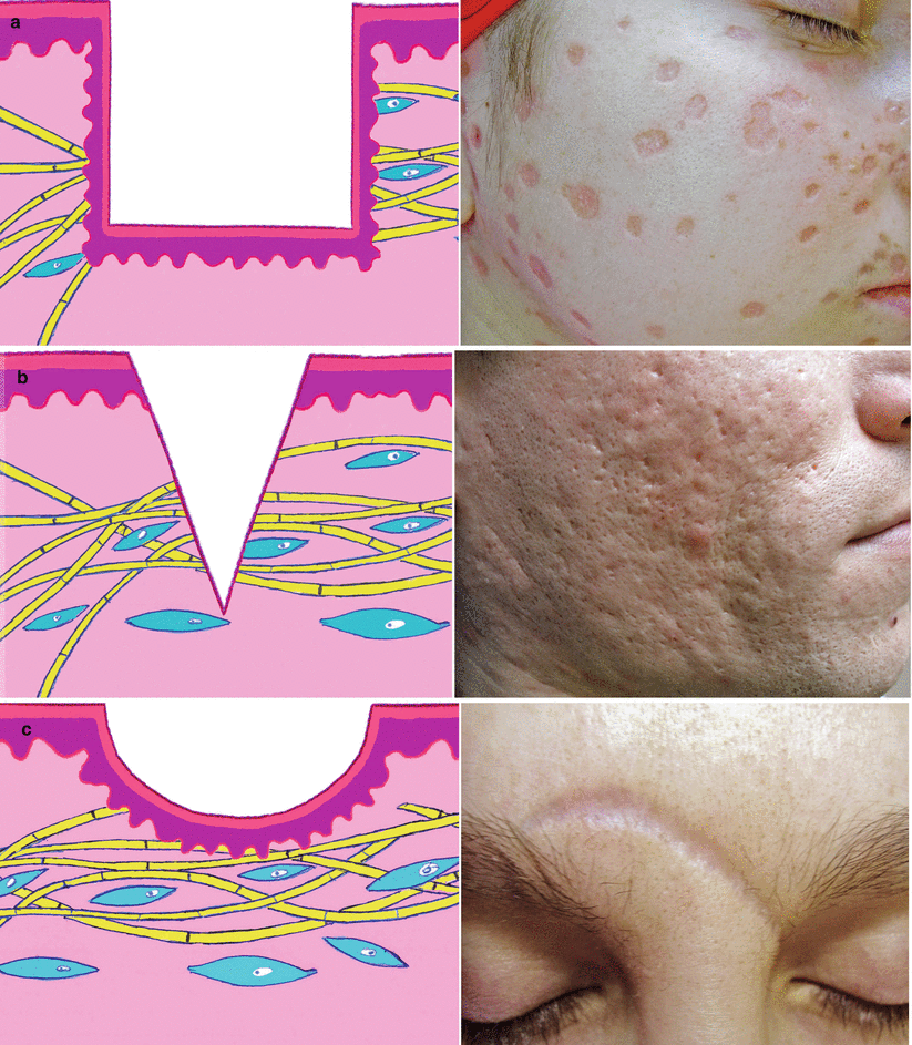 Atrophic Scars and Stretch Marks | SpringerLink