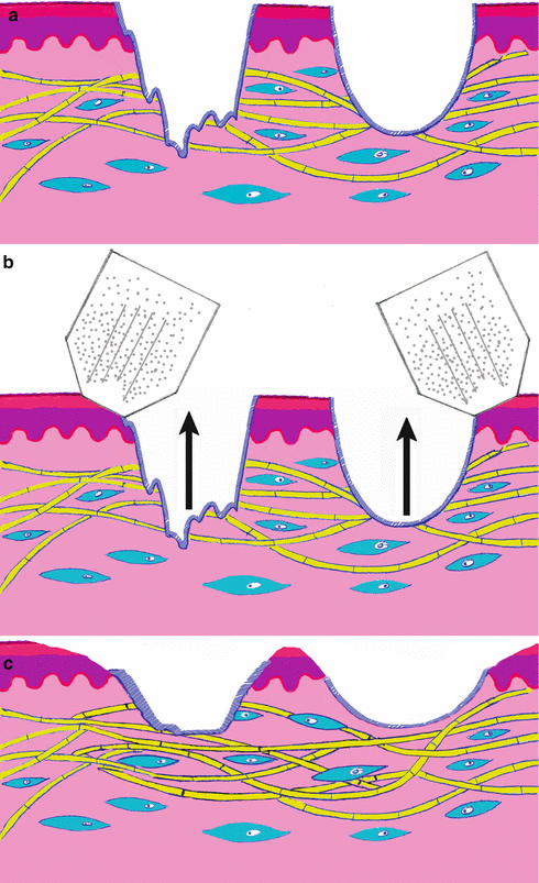 Atrophic Scars and Stretch Marks | SpringerLink
