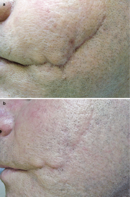 Atrophic Scars and Stretch Marks | SpringerLink