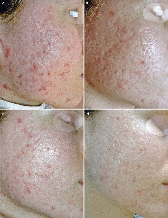 Atrophic Scars and Stretch Marks | SpringerLink