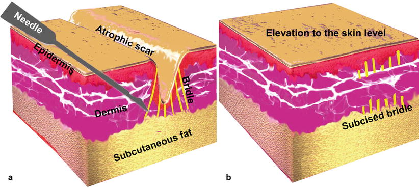 Atrophic Scars and Stretch Marks | SpringerLink
