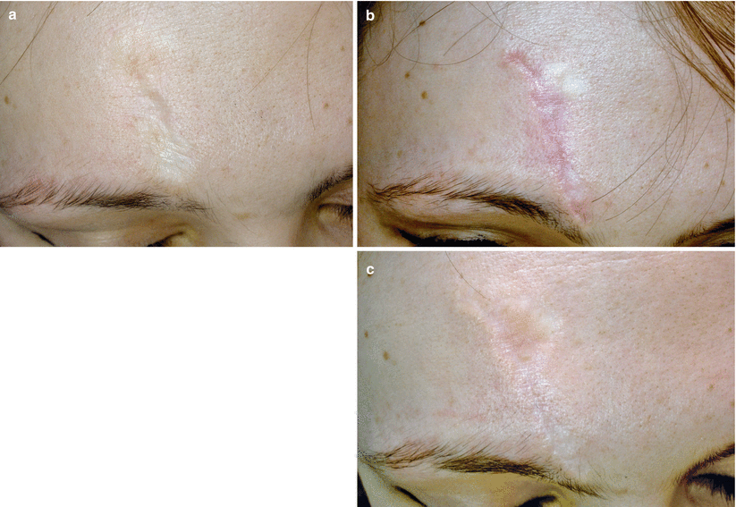 Atrophic Scars and Stretch Marks | SpringerLink