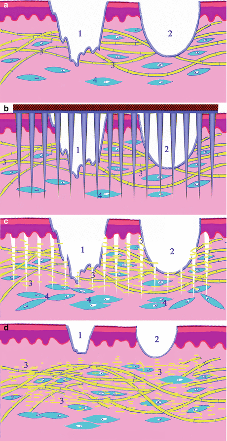 Atrophic Scars and Stretch Marks | SpringerLink