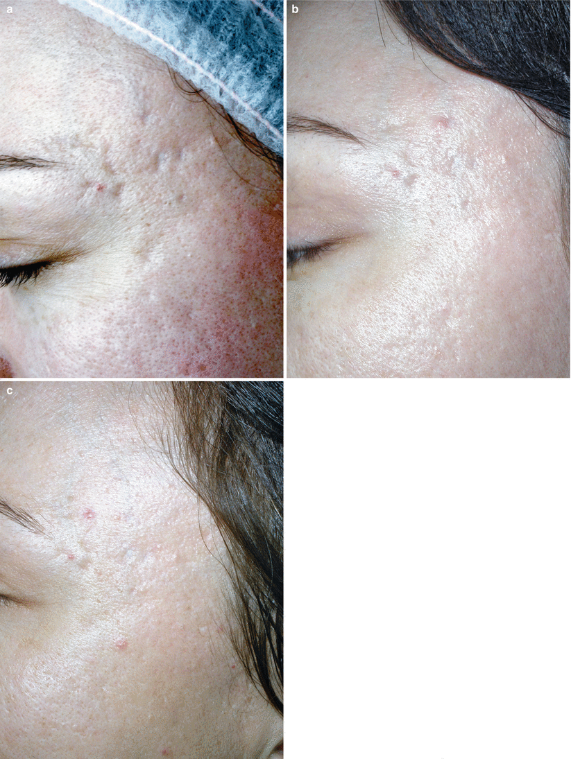 Atrophic Scars and Stretch Marks | SpringerLink