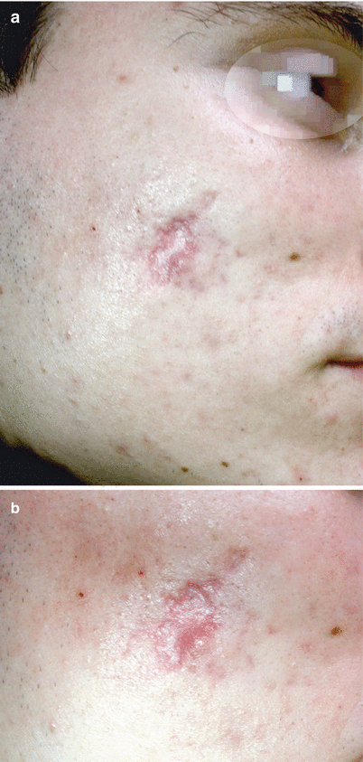 Atrophic Scars and Stretch Marks | SpringerLink