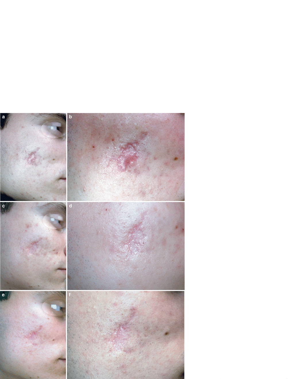 Atrophic Scars and Stretch Marks | SpringerLink