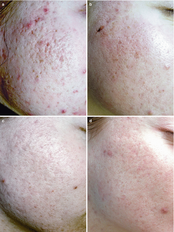 Atrophic Scars and Stretch Marks | SpringerLink