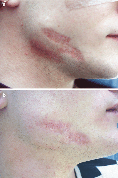 Atrophic Scars and Stretch Marks | SpringerLink