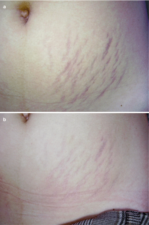 Atrophic Scars and Stretch Marks | SpringerLink