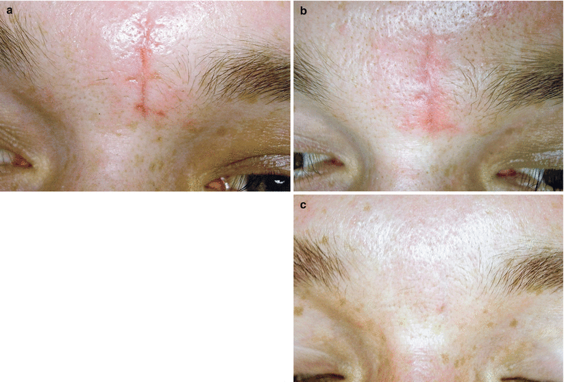 Normotrophic Scars | SpringerLink