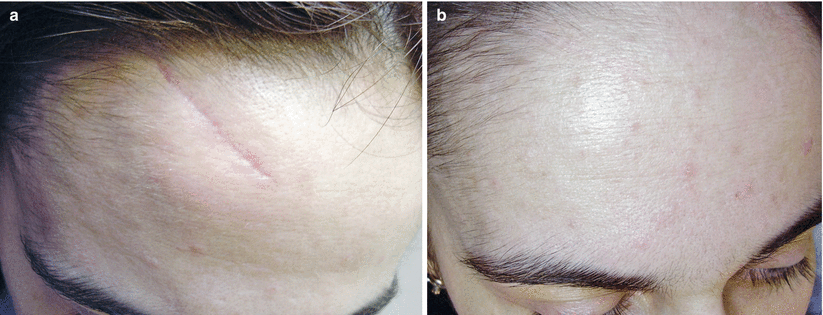 Normotrophic Scars | SpringerLink