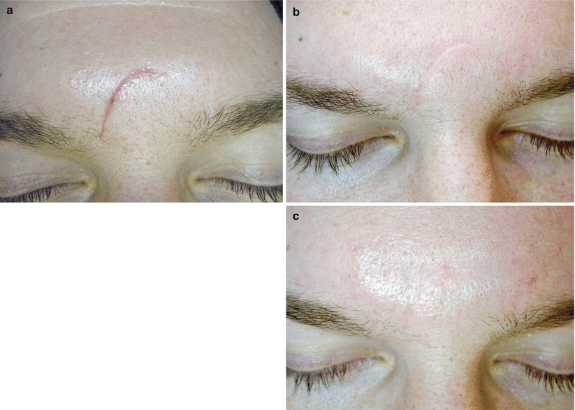 Normotrophic Scars | SpringerLink