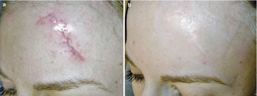 Normotrophic Scars | SpringerLink