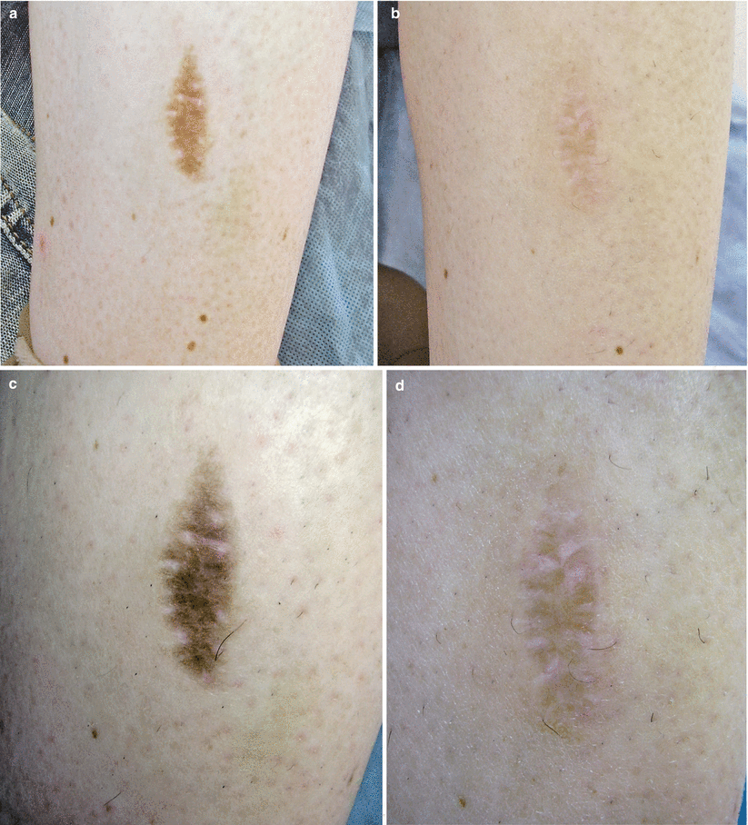 Normotrophic Scars | SpringerLink