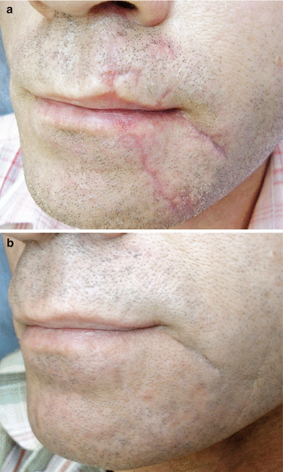 Normotrophic Scars | SpringerLink