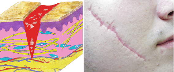 Normotrophic Scars | SpringerLink