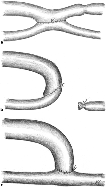 AV-Fisteln | SpringerLink