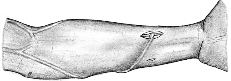 AV-Fisteln | SpringerLink