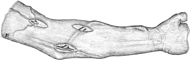 AV-Fisteln | SpringerLink