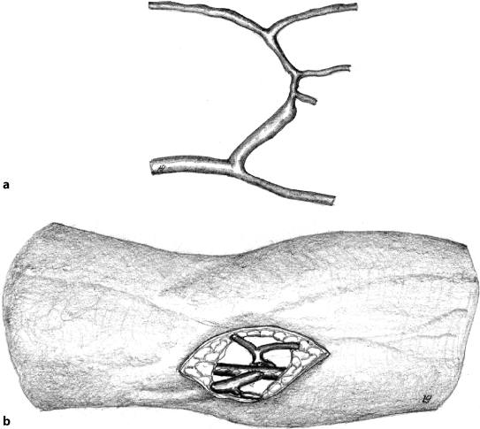 AV-Fisteln | SpringerLink