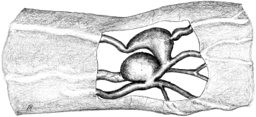 AV-Fisteln | SpringerLink