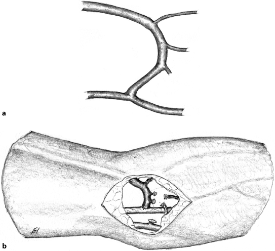 AV-Fisteln | SpringerLink