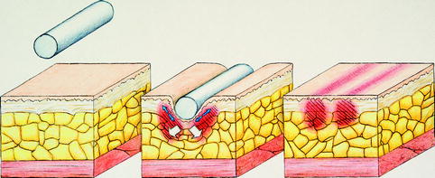 Blunt-Force Trauma: Bruises | SpringerLink