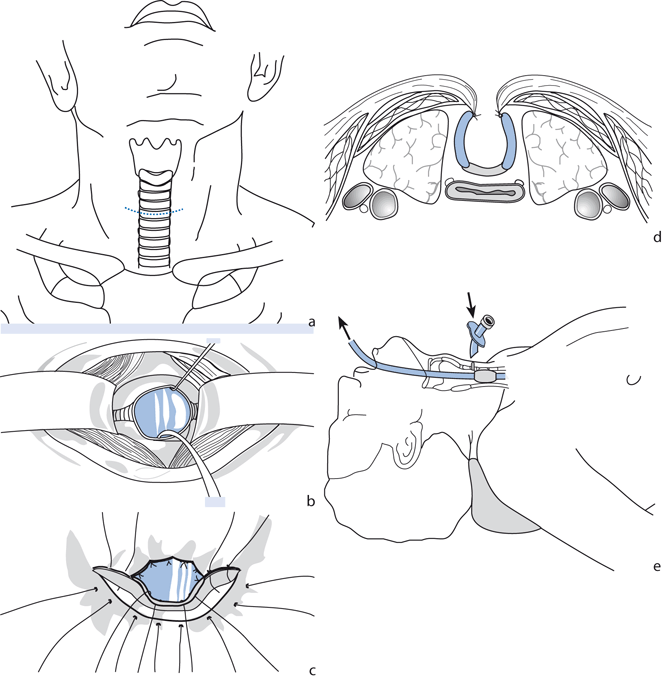 Tracheotomie | SpringerLink