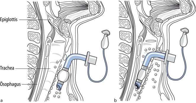Tracheotomie | SpringerLink