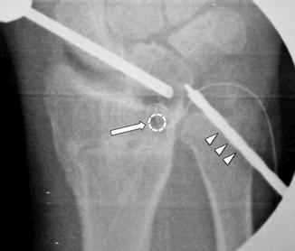 DRUJ Instability: Arthroscopic Ligament Reconstruction | SpringerLink