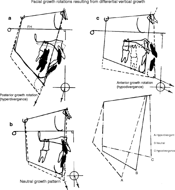Facial and Palatal Growth | SpringerLink