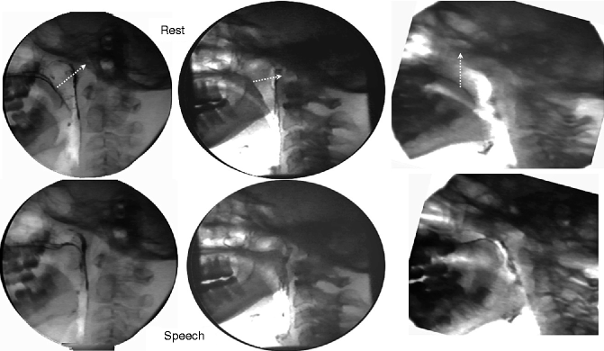 The Velopharyngeal Mechanism | SpringerLink