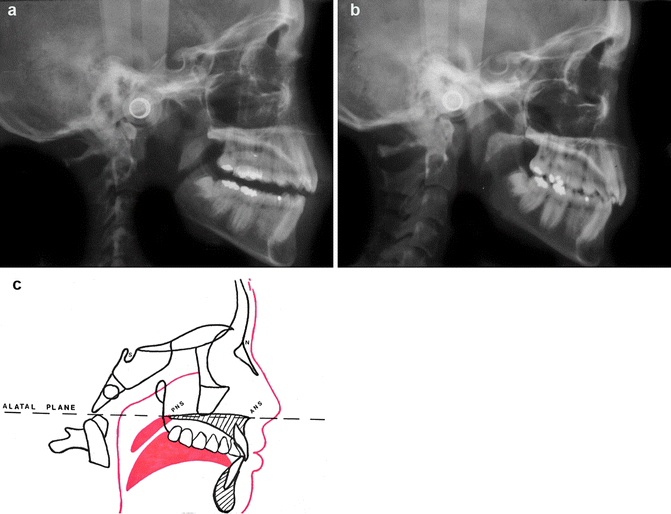 Palatal Lift Prosthesis for the Treatment of Velopharyngeal ...