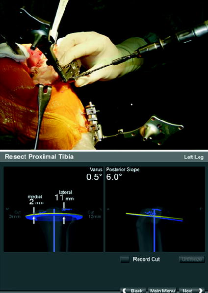 TKA: Measured Resection Technique | SpringerLink