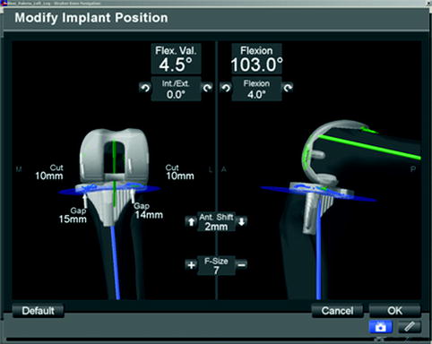 TKA: Measured Resection Technique | SpringerLink