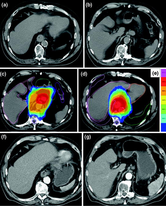 Radiotherapy of Gastroesophageal Junction Cancer | SpringerLink