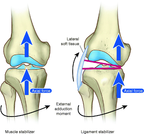 The ACL: Anatomy, Biomechanics, Mechanisms of Injury, and the Gender ...