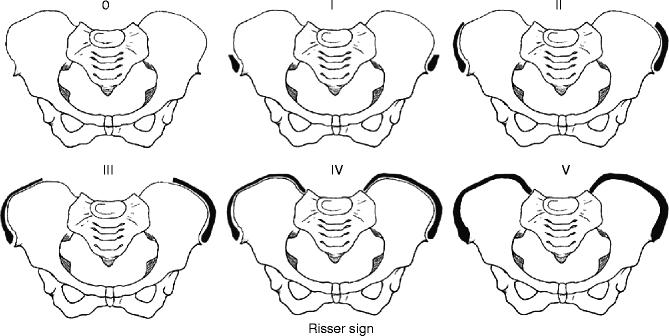 Scoliosis | SpringerLink