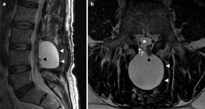 Management of Dural Tears in Spinal Surgery | SpringerLink