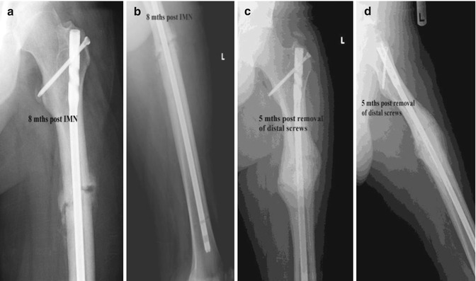 Management of Delayed Union, Non-Union and Mal-Union of Long Bone ...