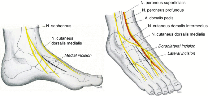 Midfoot Arthrodesis | SpringerLink