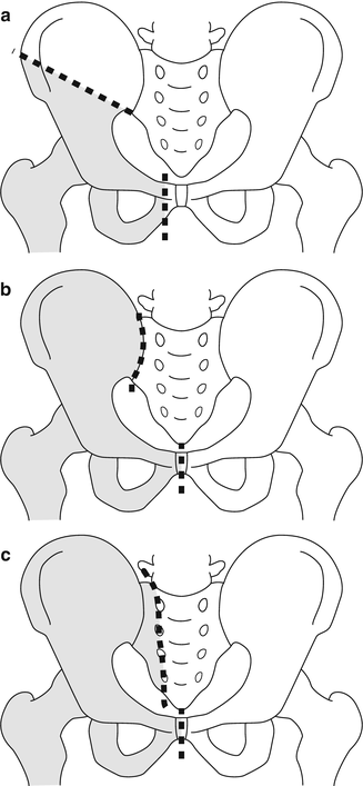 Disarticulation of the Hip and Hemipelvectomy | SpringerLink