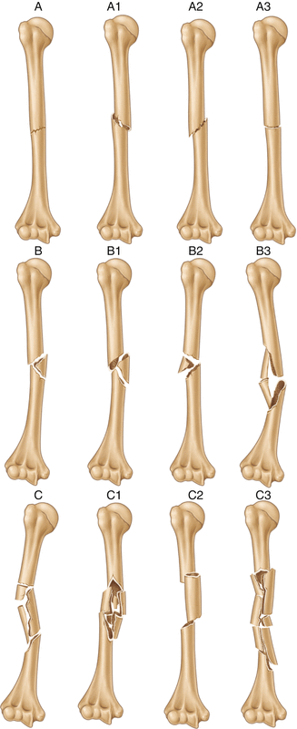 Humeral Shaft Fractures - Principles of Management | SpringerLink