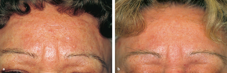 Behandlung benigner Tumoren und organoider Naevi | SpringerLink