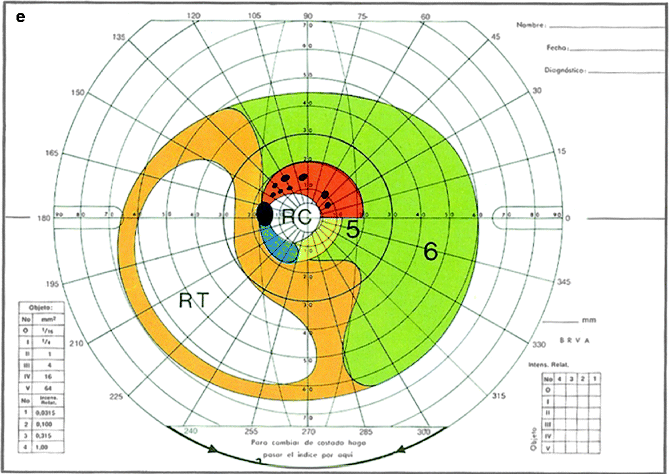 Visual Field Changes in Glaucoma | SpringerLink