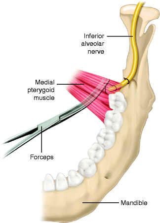 Surgical Management of Inferior Alveolar Nerve Injuries | SpringerLink